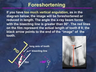 radio-graphic-techniques-bisecting-and-occlusal | PDF