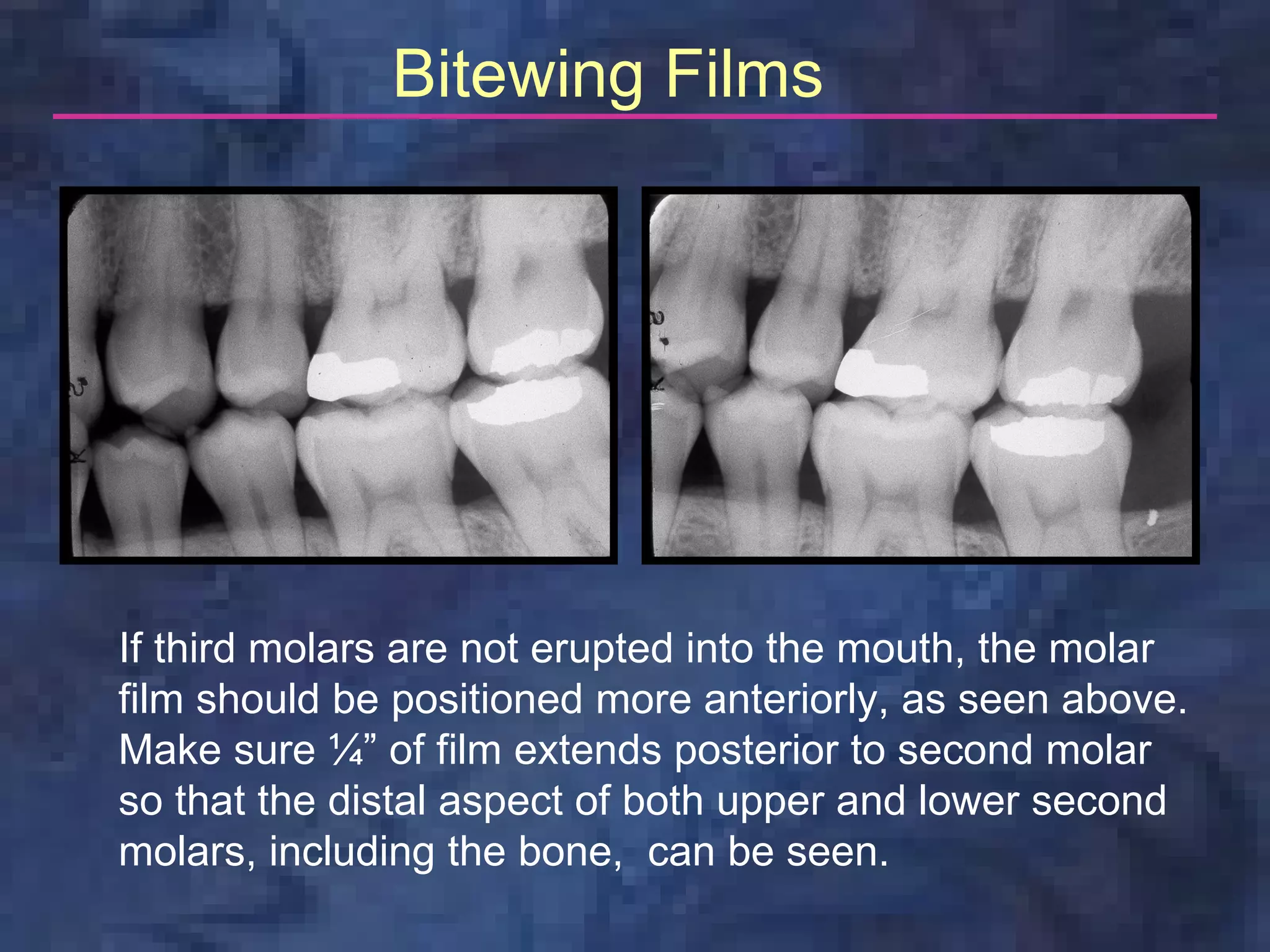 radiology-bitewing-technique | PDF