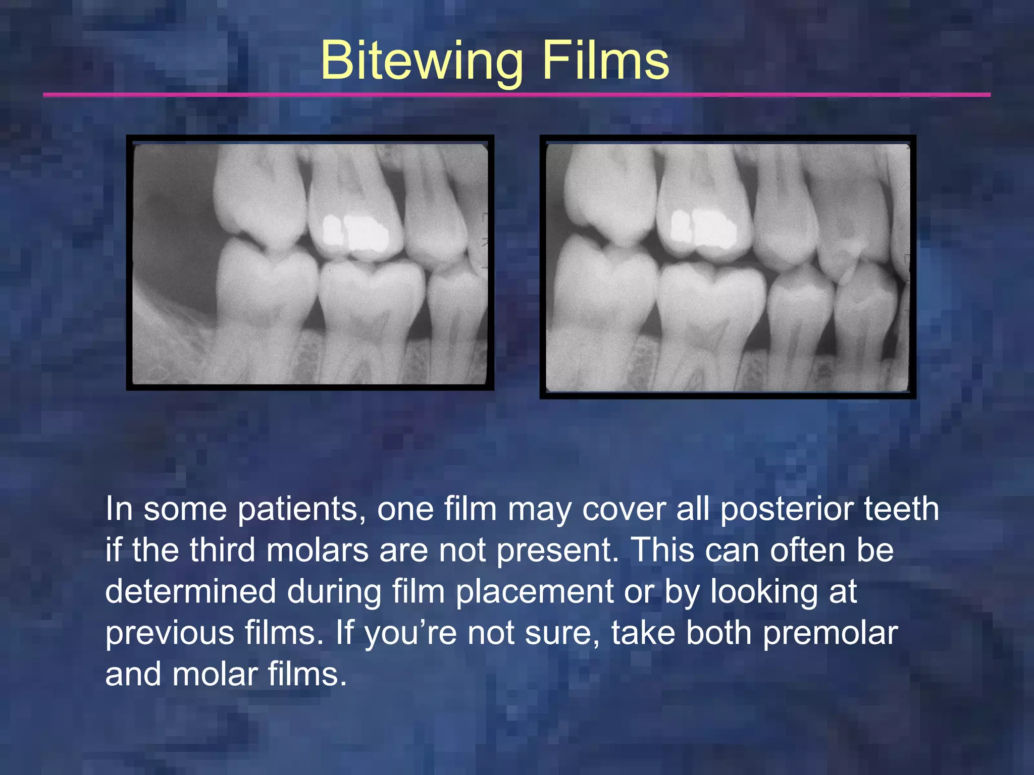radiology-bitewing-technique | PDF