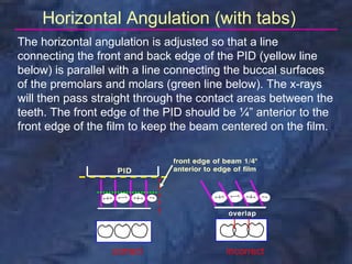 radiology-bitewing-technique | PDF