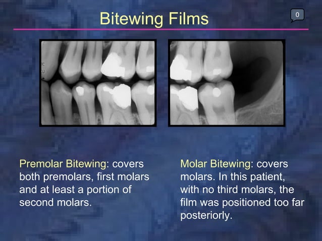 radiology-bitewing-technique | PDF | Dental Health | Diseases and Conditions