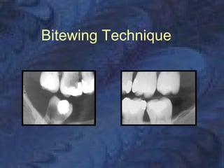 radiology-bitewing-technique | PDF