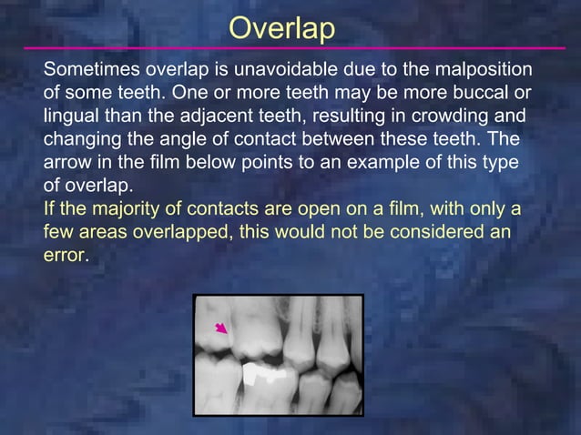 radiology-bitewing-technique | PDF | Dental Health | Diseases and ...
