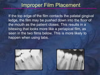 radiology-bitewing-technique | PDF