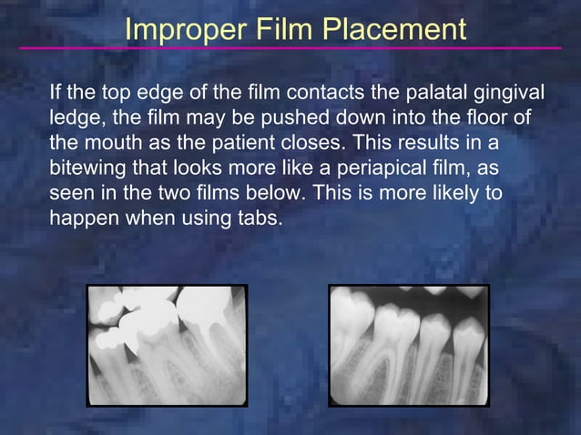 radiology-bitewing-technique | PDF | Dental Health | Diseases and ...