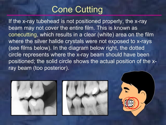 radiology-bitewing-technique | PDF | Dental Health | Diseases and Conditions