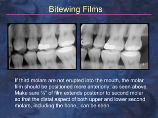radiology-bitewing-technique | PPT