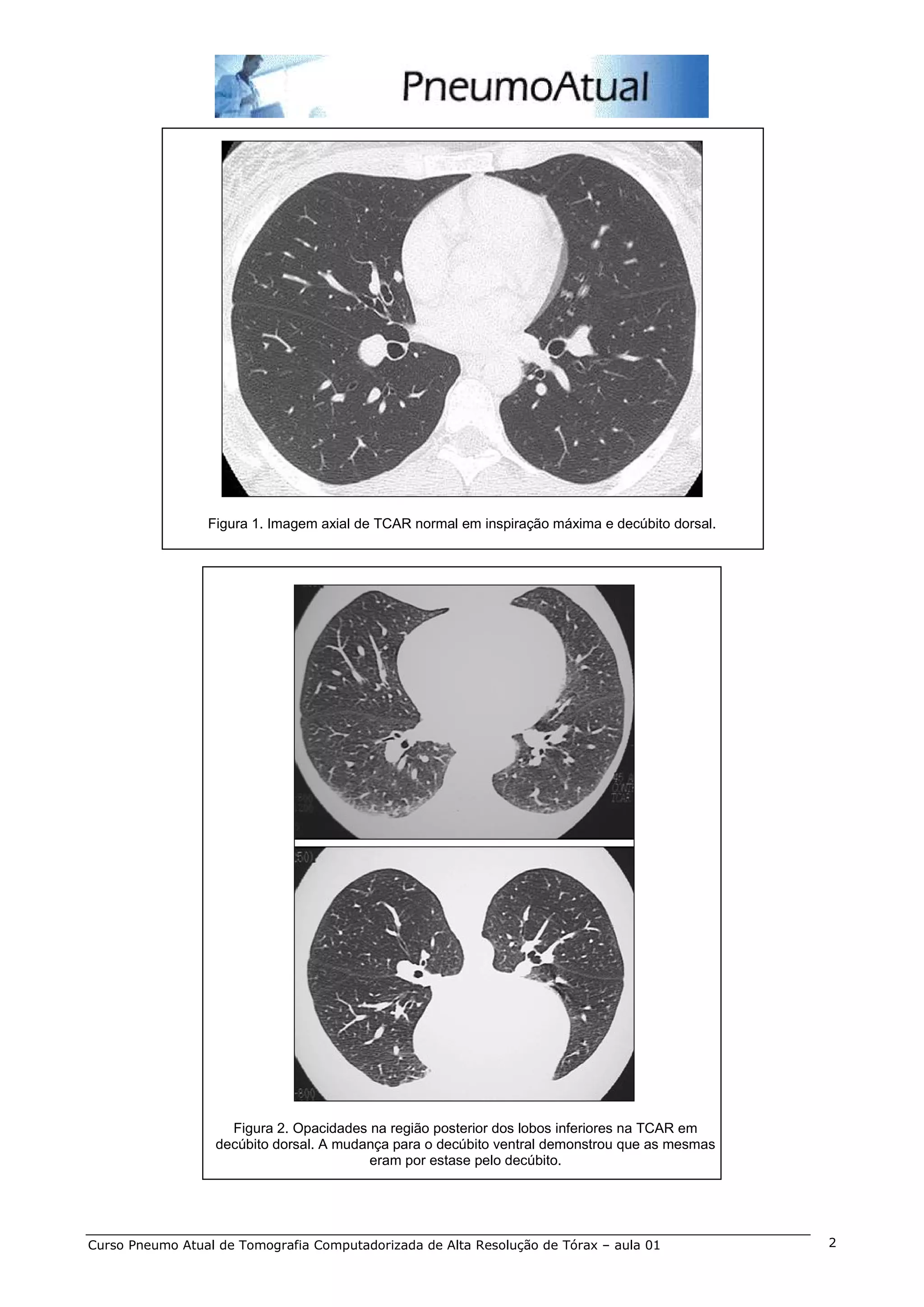 Aula 1 - tomografia de tórax de alta resolução | PDF