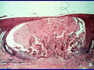 Infection of oral mucosa | PPT