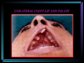 cleft-lip-palate | PPT