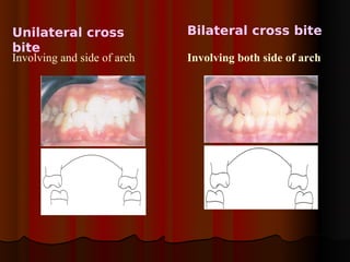 Unilateral Posterior Crossbite