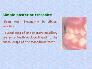 crossbite | PDF