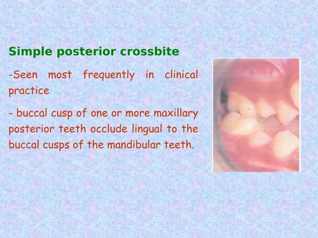crossbite | PDF