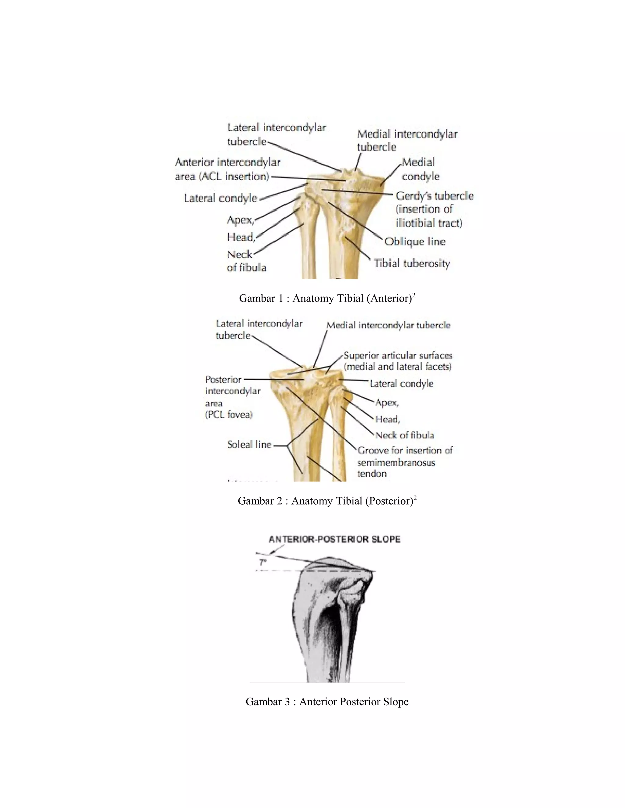 320844327 tibial-plateau | PDF
