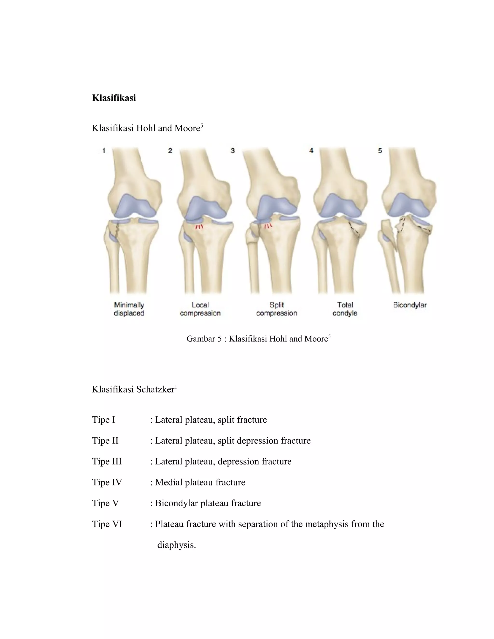 320844327 tibial-plateau | PDF