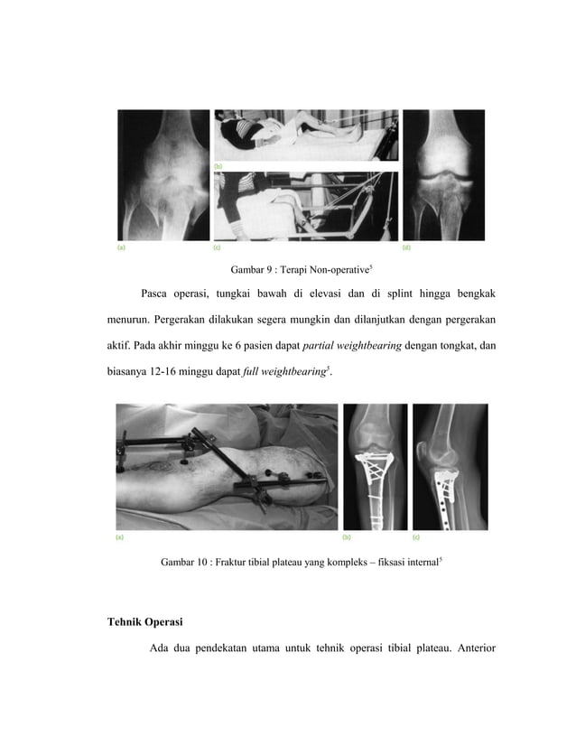 320844327 tibial-plateau | PDF