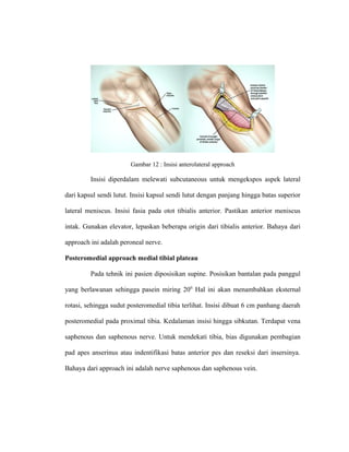 320844327 tibial-plateau | PDF