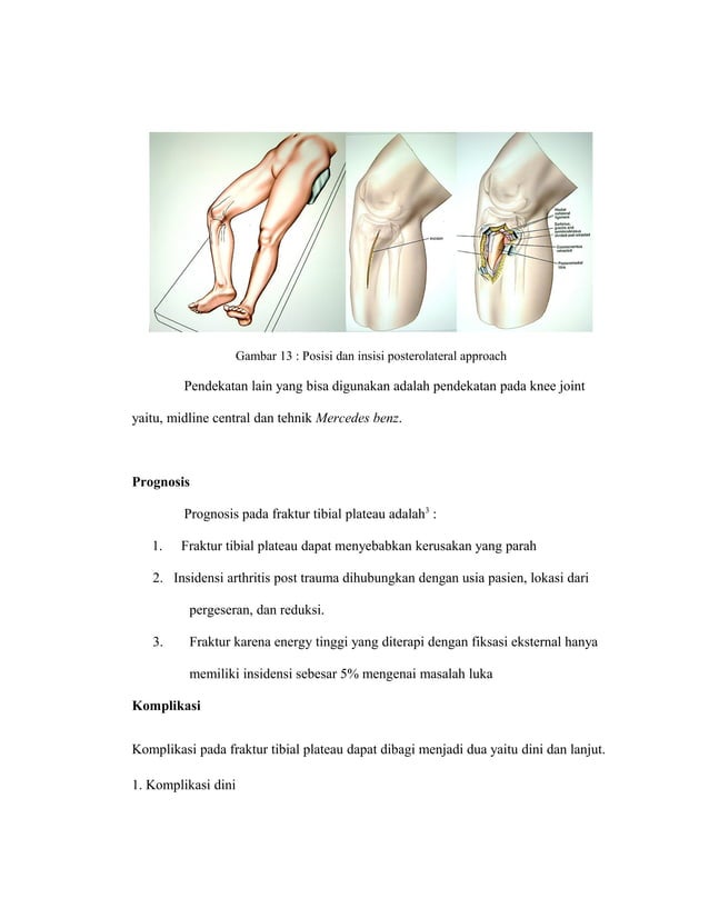 320844327 tibial-plateau | PDF