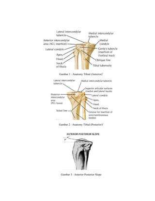 320844327 tibial-plateau | DOC
