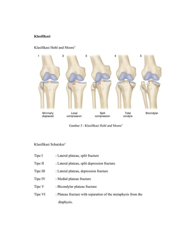 320844327 tibial-plateau | PDF