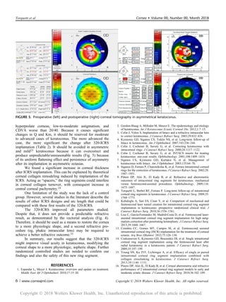 320º Intra Corneal Ring Segment - Ferrara Ring™ | PDF | Eye and Vision Conditions | Diseases and ...