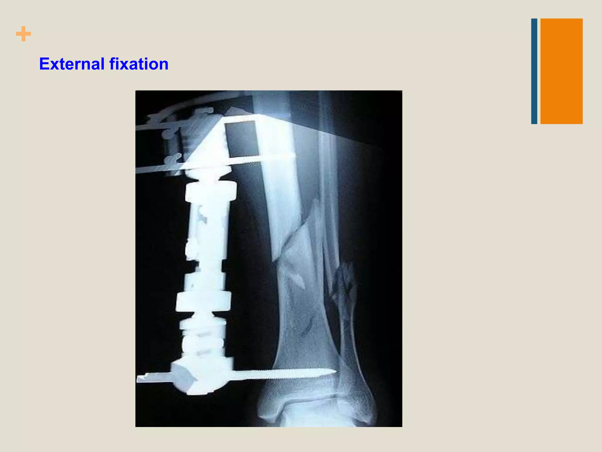 principles of fracture fixation | PPTX