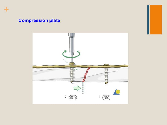 principles of fracture fixation | PPTX