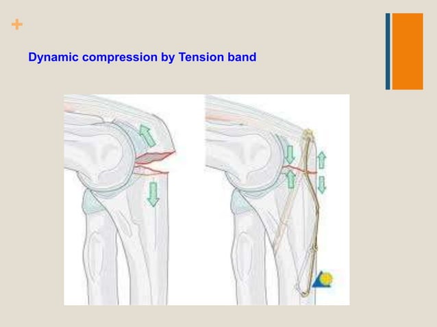 principles of fracture fixation | PPTX
