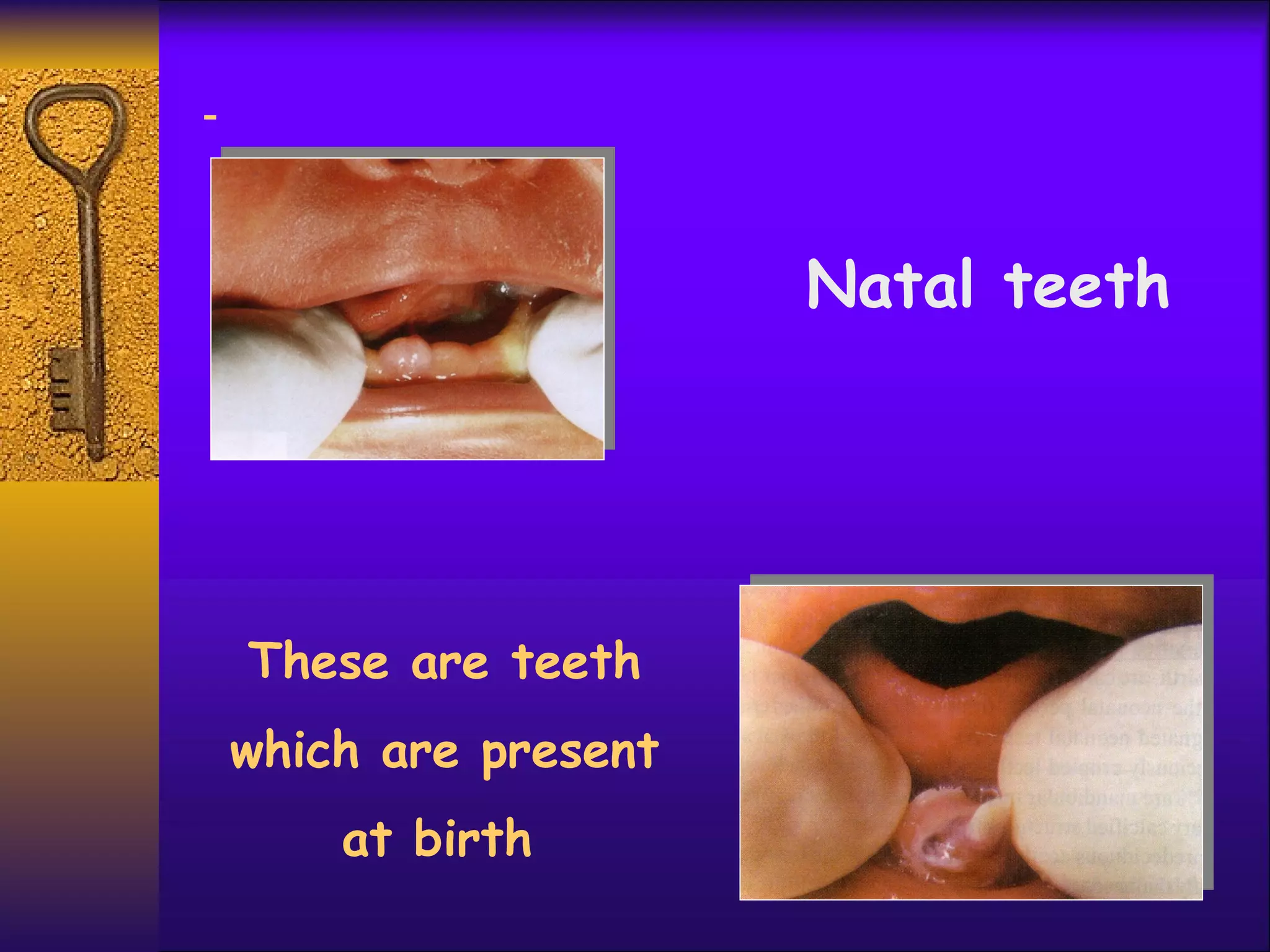 natal neonatal teeth-pedo | PPT