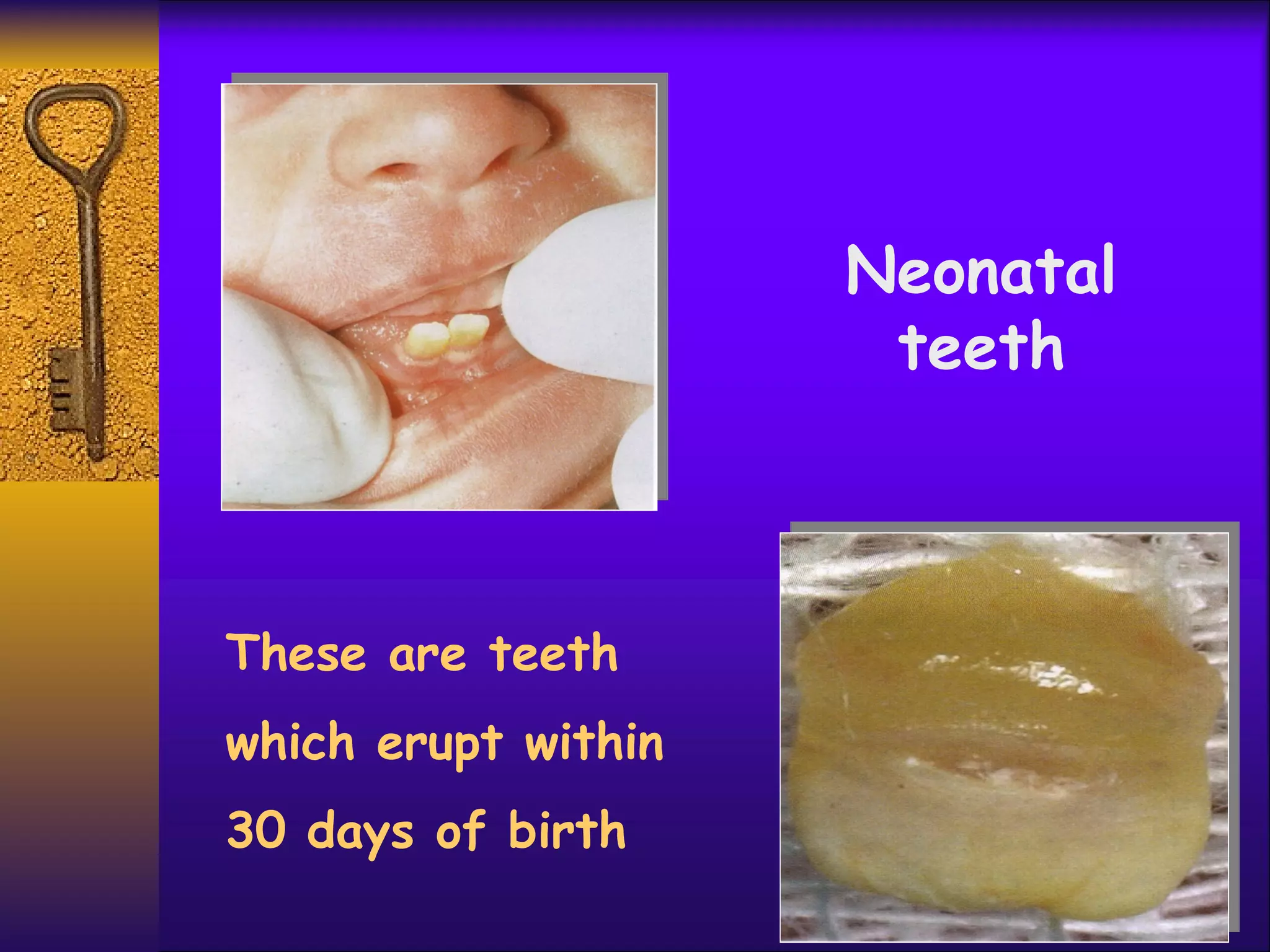 natal neonatal teeth-pedo | PPT