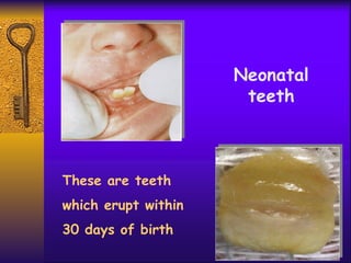 natal neonatal teeth-pedo | PPT