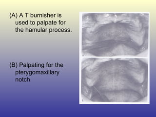 Pterygomaxillary Notch