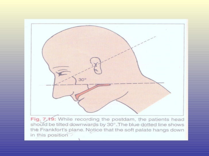 posterior palatal seal