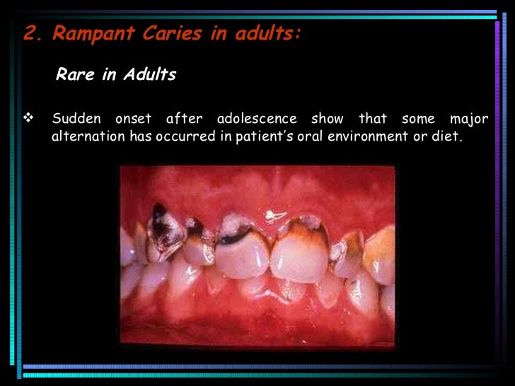 rampant caries