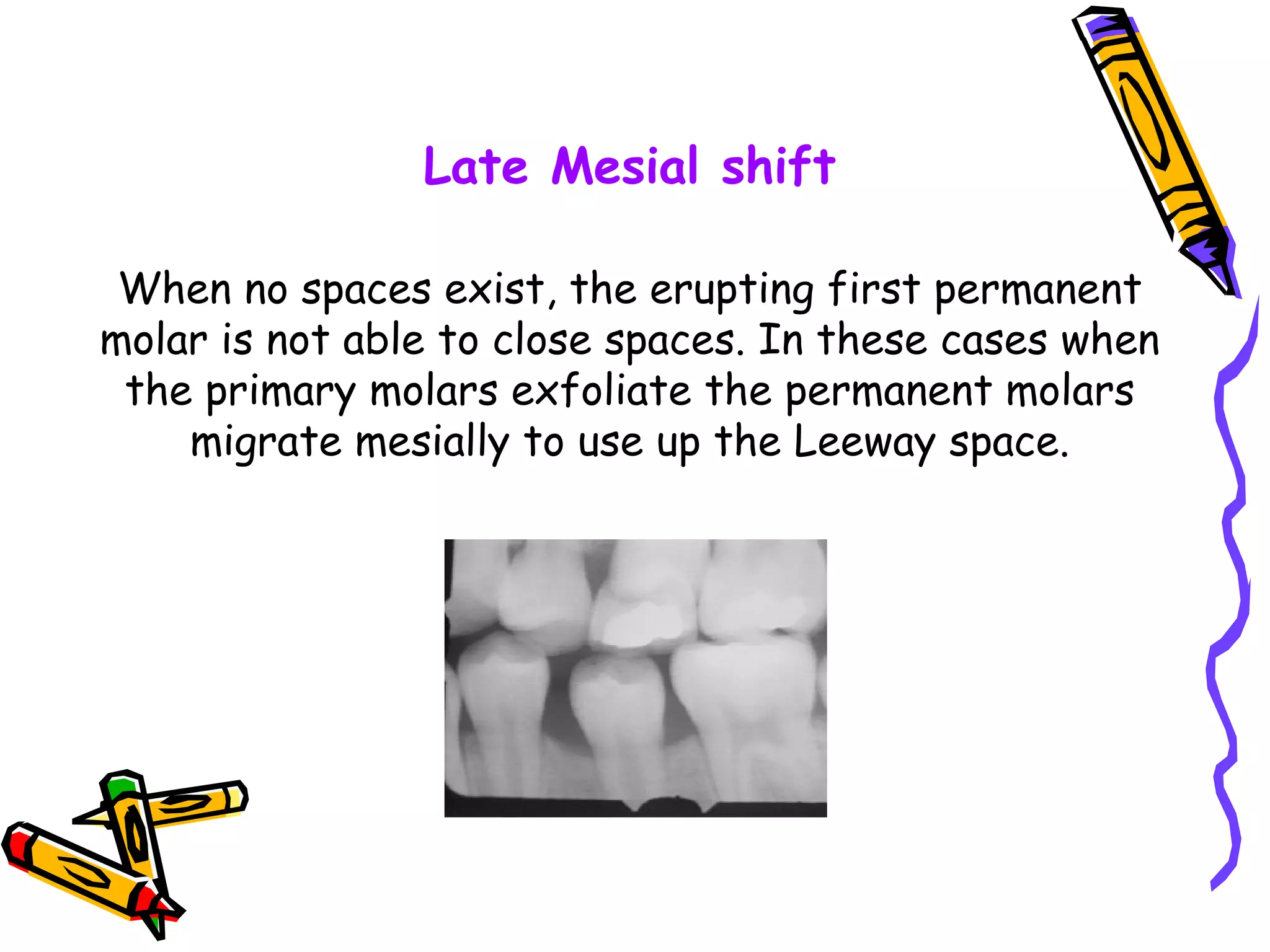 the-mixed-dentition-pedodontics | PPT