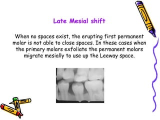 the-mixed-dentition-pedodontics | PPT