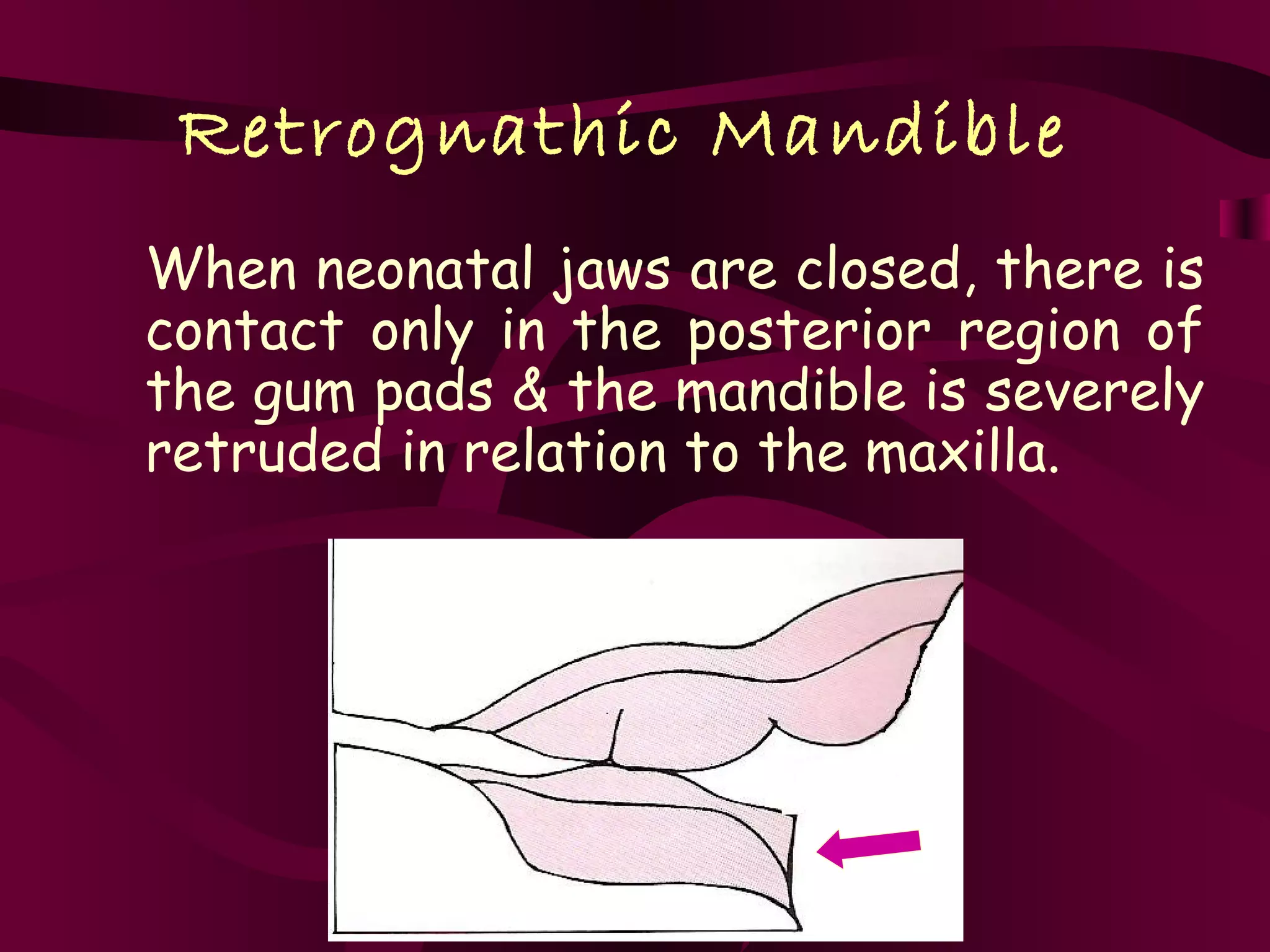 transient-malocclusions-pedodontics | PPT