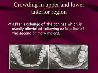 transient-malocclusions-pedodontics | PPT