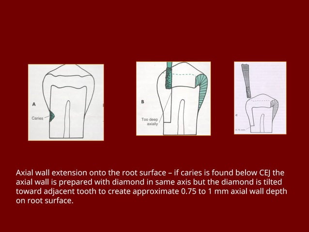 322441307-tooth-preparation-for-composite-ppt.ppt