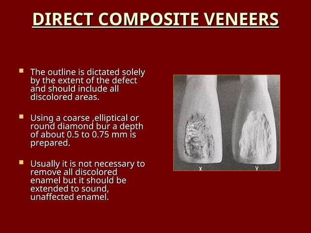 322441307-tooth-preparation-for-composite-ppt.ppt