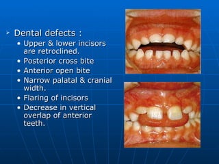 mouth-breathing-habit-in-children-pedo | PPT