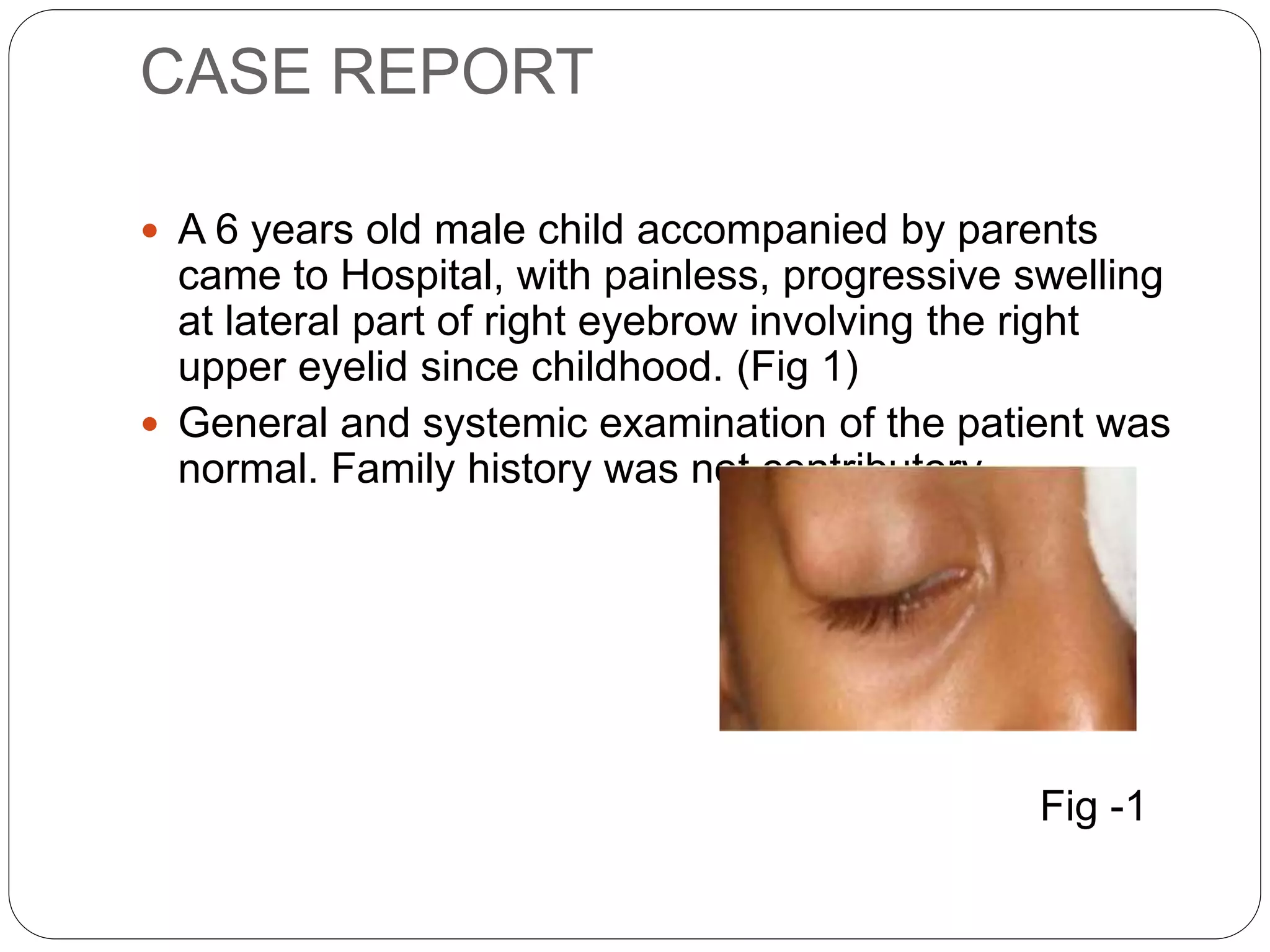 A Rare Case Of Periorbital Dermoid Cyst In Child. | PPTX | Eye and ...