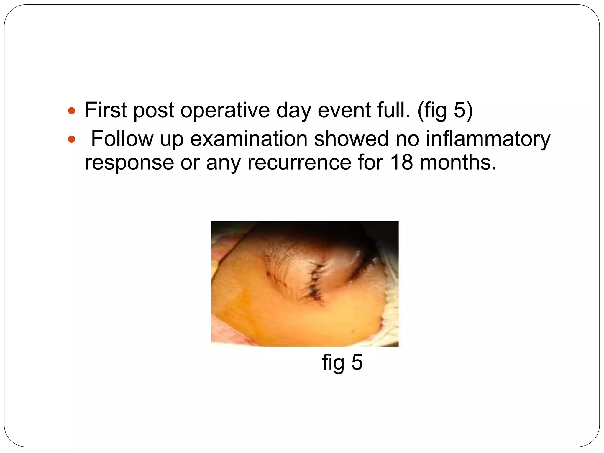 A Rare Case Of Periorbital Dermoid Cyst In Child. | PPTX | Eye and ...