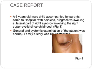 A Rare Case Of Periorbital Dermoid Cyst In Child. | PPTX
