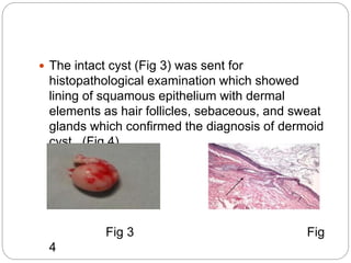 A Rare Case Of Periorbital Dermoid Cyst In Child. | PPT