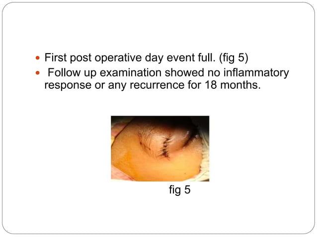 A Rare Case Of Periorbital Dermoid Cyst In Child. | PPTX | Eye and ...