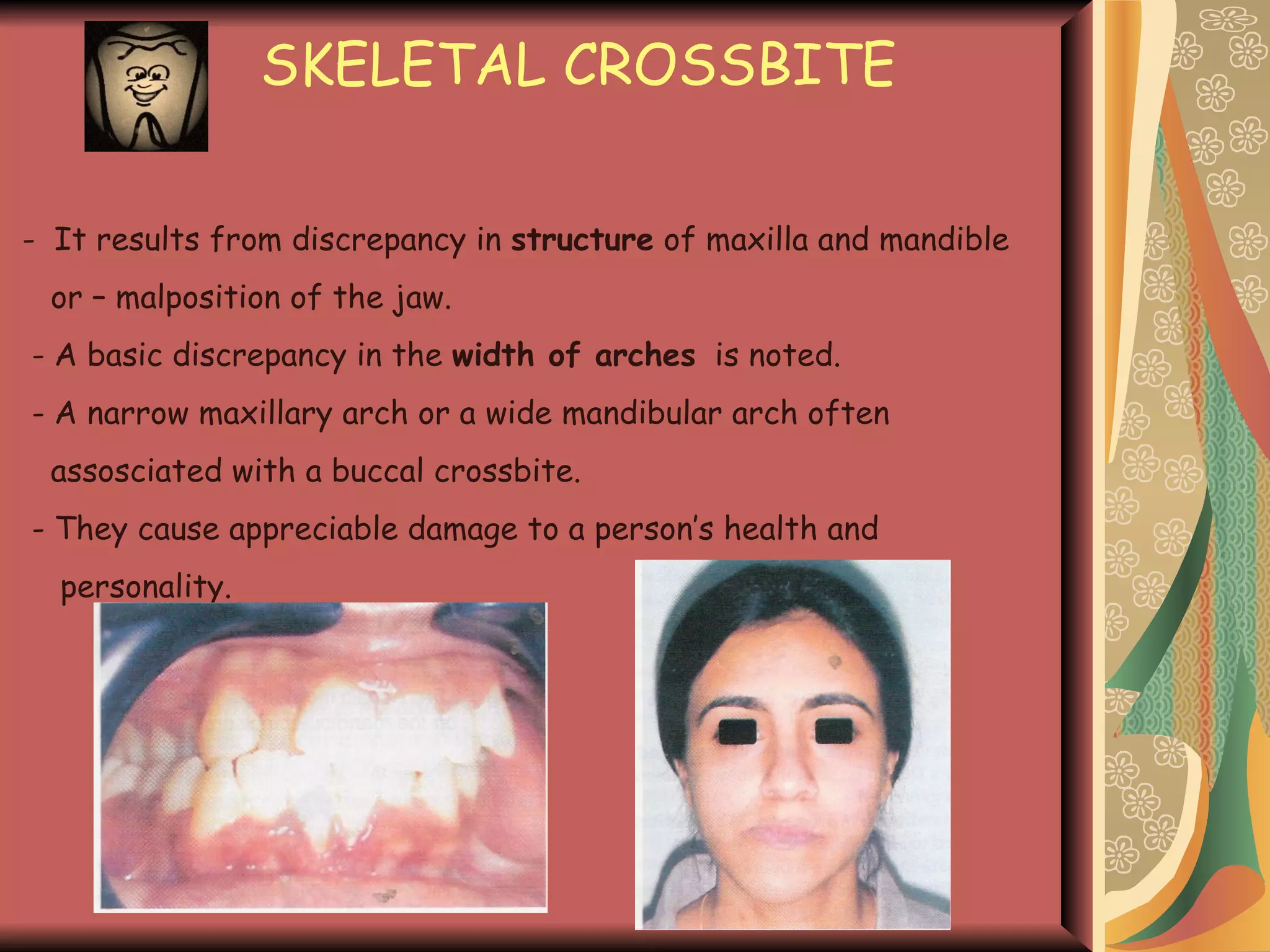 posterior crossbite in primary and mixed dentition etiology and ...