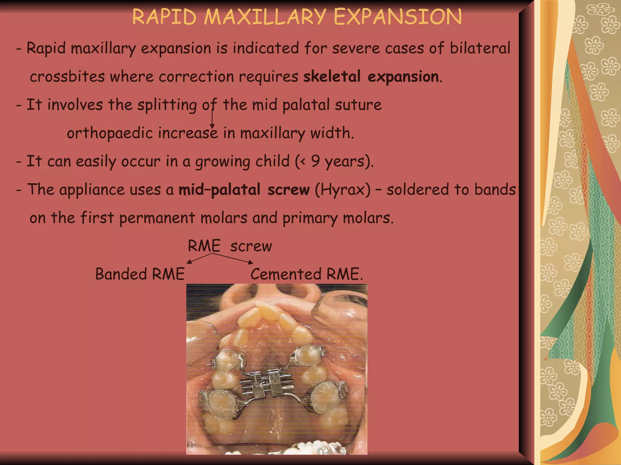 posterior crossbite in primary and mixed dentition etiology and ...