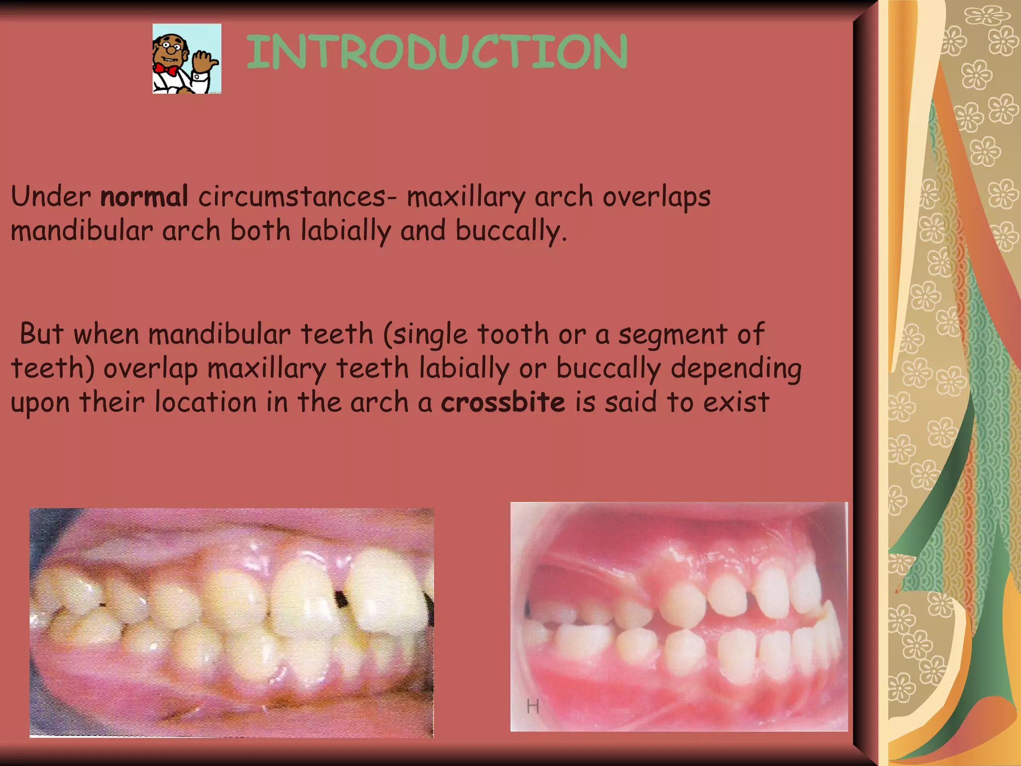 posterior crossbite in primary and mixed dentition etiology and ...