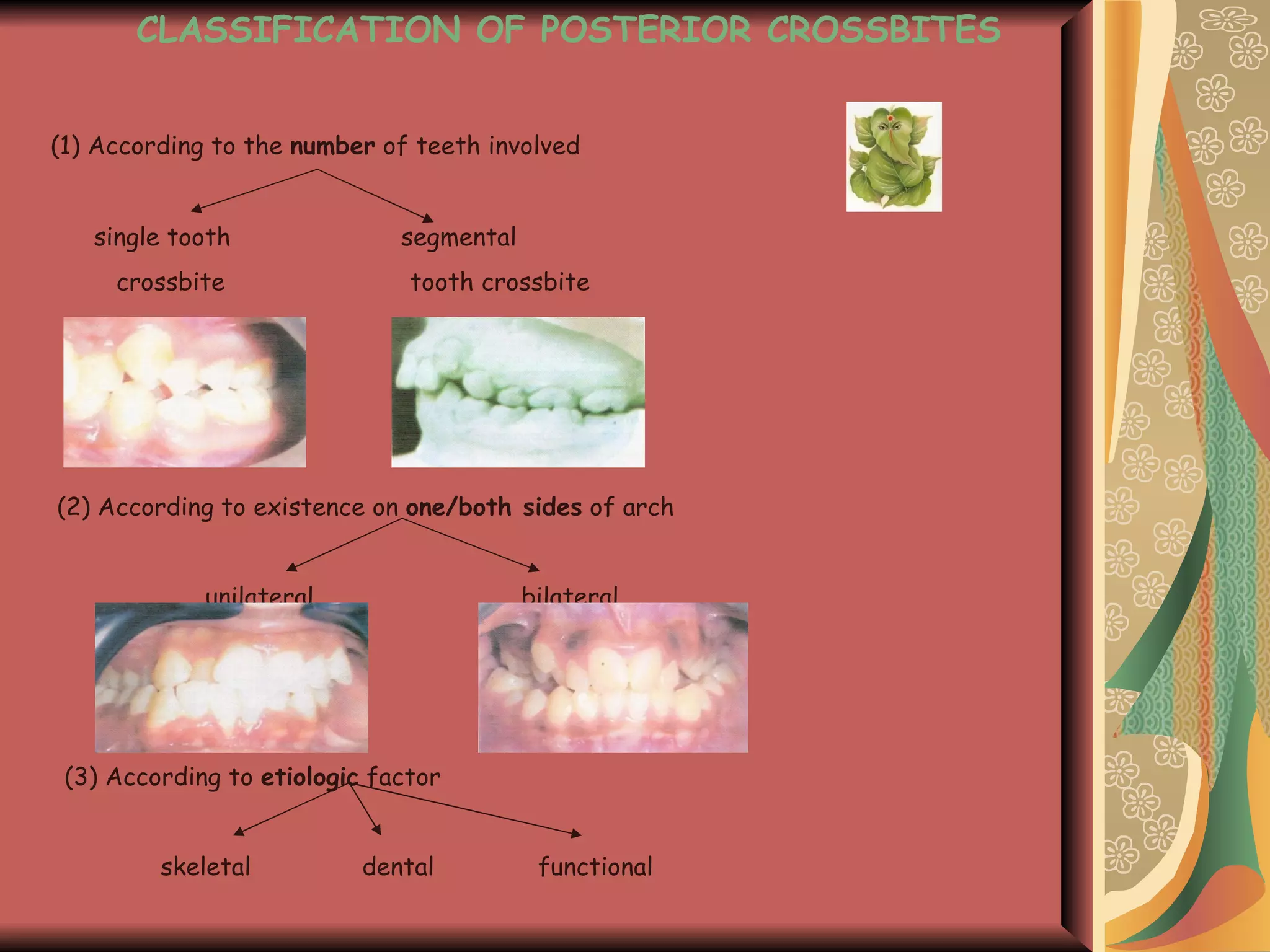 posterior crossbite in primary and mixed dentition etiology and ...